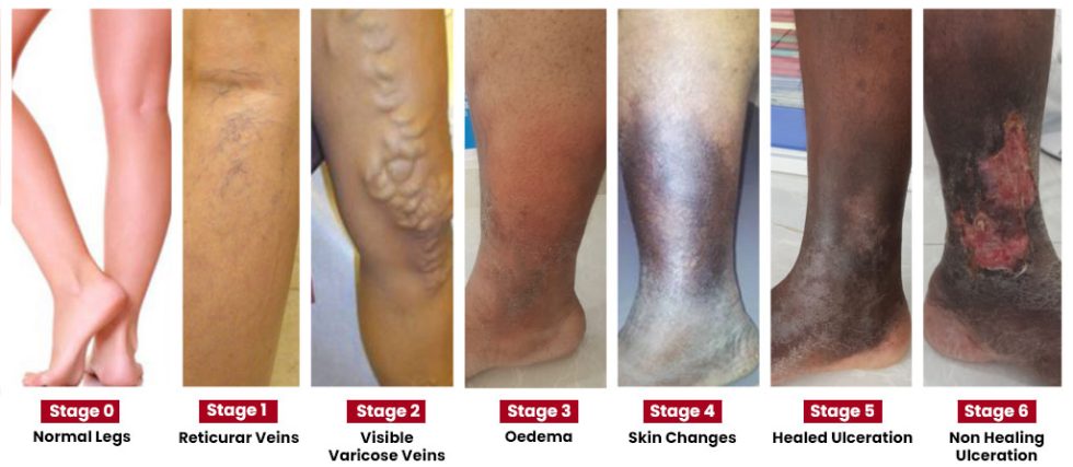 Best Varicose Veins Treatment in Mumbai - Dr. Kunal Arora