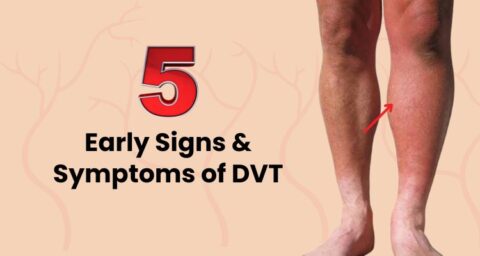 5 Early Signs of Deep Vein Thrombosis (DVT) You Shouldn’t Ignore